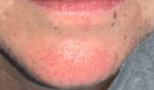 Broken Capillary & Angioma Treatment Severna Park, MD